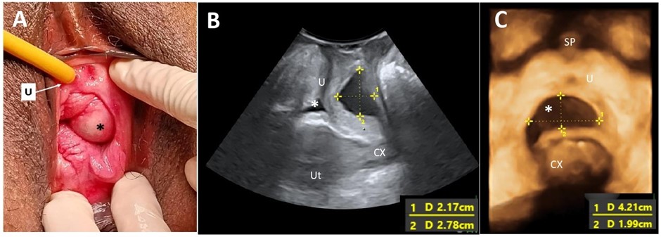 Gartner’s Duct Cyst Impersonating Prolapse: A Case Report | Medicine ...